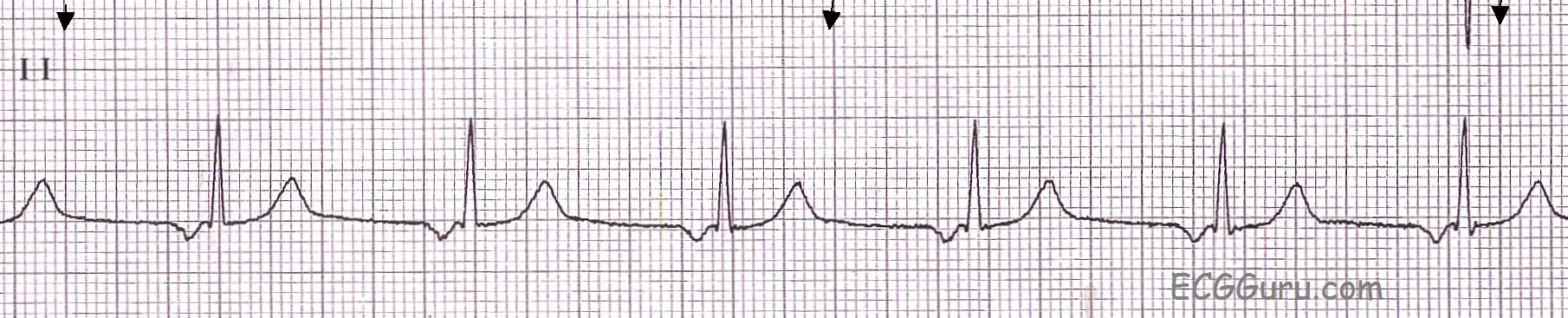 ECG Basics: Junctional Rhythm | ECG Guru - Instructor Resources ECG Basics: Junctional Rhythm | ECG Guru - Instructor Resources